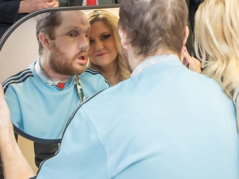 Survivor of suicide attempt receives innovative face transplant: ‘It ...